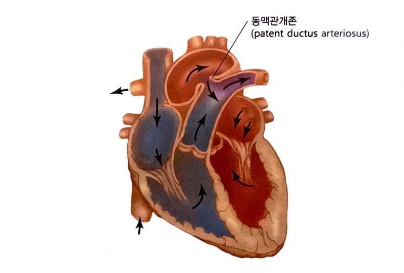 아동간호학 건강 회복 심혈관 문제 청색증좌우단락동맥관개존증심방중격결손심실중격결손우좌단락팔로4징후삼첨판폐쇄