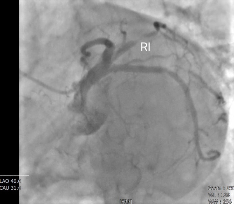 Stent 시술 환자, PCI 영상 기록하기 : 네이버 블로그