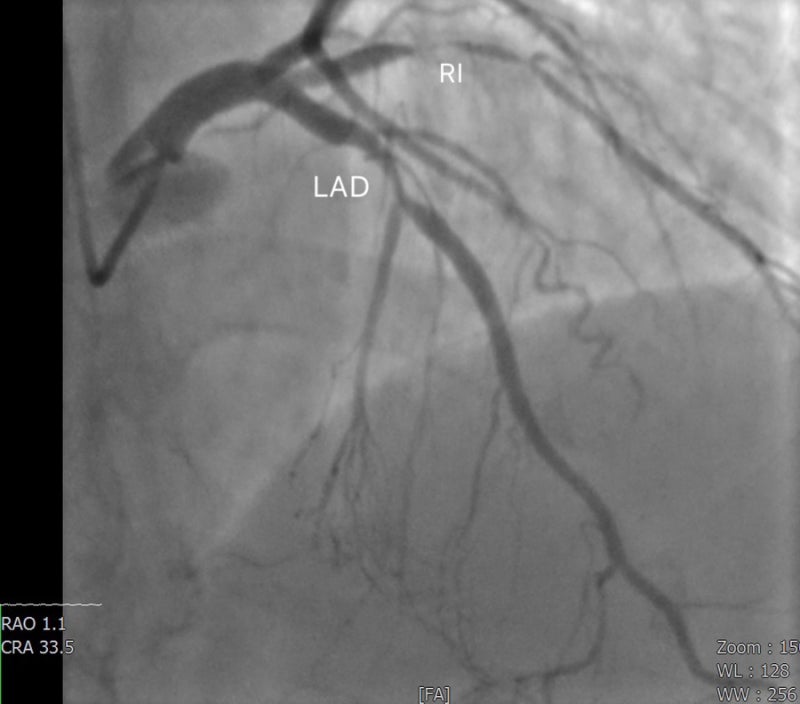 Stent 시술 환자, PCI 영상 기록하기 : 네이버 블로그