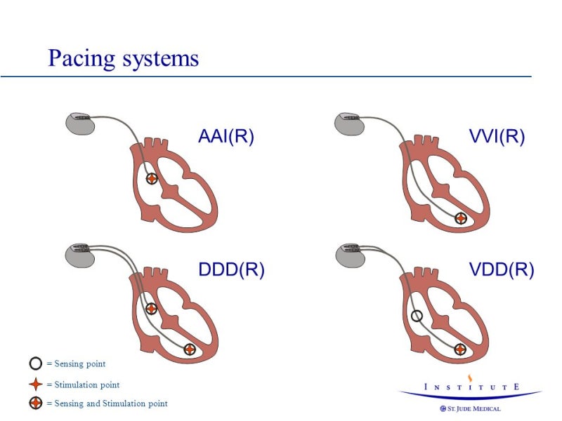 인공심박동기 pacemaker AAI, VVI, VDD, DDD : 네이버 블로그