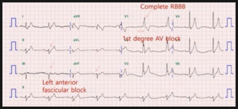 trifascicular block ; 위험할 수도 있는 심전도 : 네이버 블로그