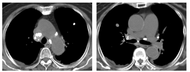 비활동성 폐결핵, 석회화 림프절, 석회화 결절, Ranke complex : 네이버 블로그