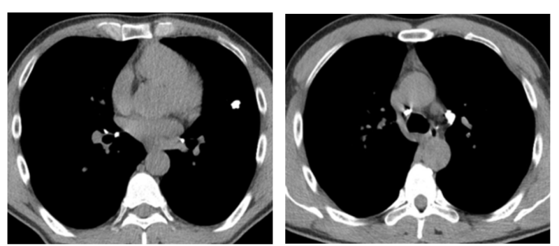 비활동성 폐결핵, 석회화 림프절, 석회화 결절, Ranke complex : 네이버 블로그