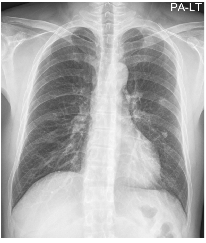 비활동성 폐결핵, 석회화 림프절, 석회화 결절, Ranke complex : 네이버 블로그