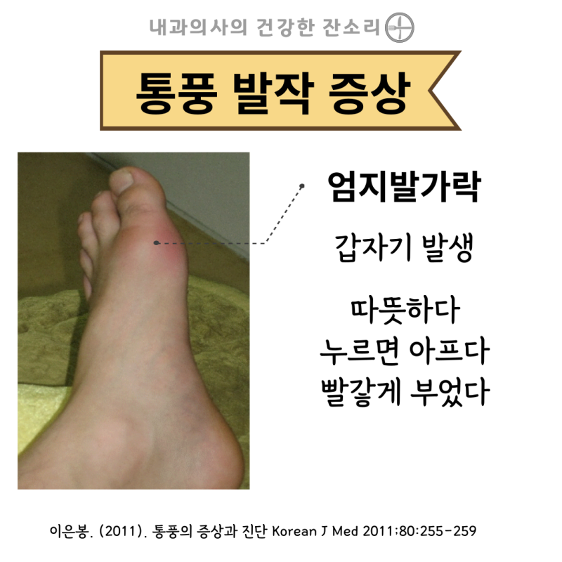 통풍 초기 증상 엄지발가락이 부었어요 통풍 맞나요 통풍의 진단 네이버 블로그
