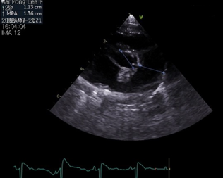 Type III 동맥관개존증(PDA) 환자에서 ACDO를 사용한 수술 증례 : 네이버 블로그