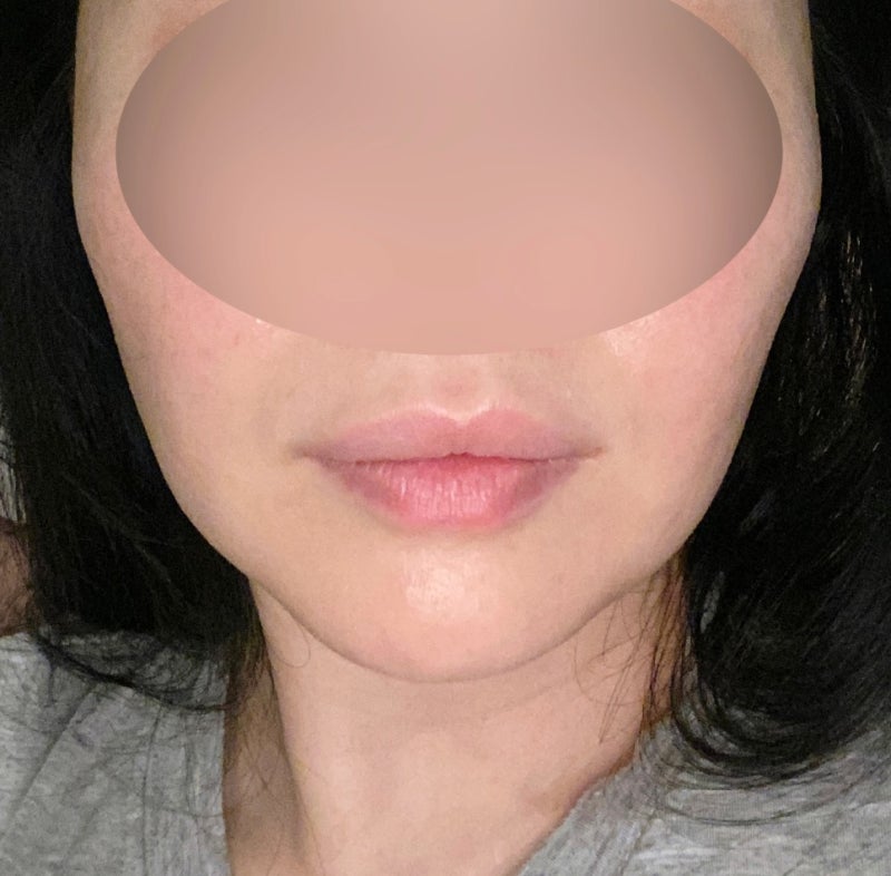 얼굴 윤곽주사 내돈내산 3회차 후기 통증 효과 멍 부작용 네이버 블로그