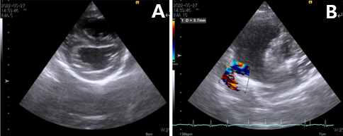 Type III 동맥관개존증(PDA) 환자에서 ACDO를 사용한 수술 증례 : 네이버 블로그