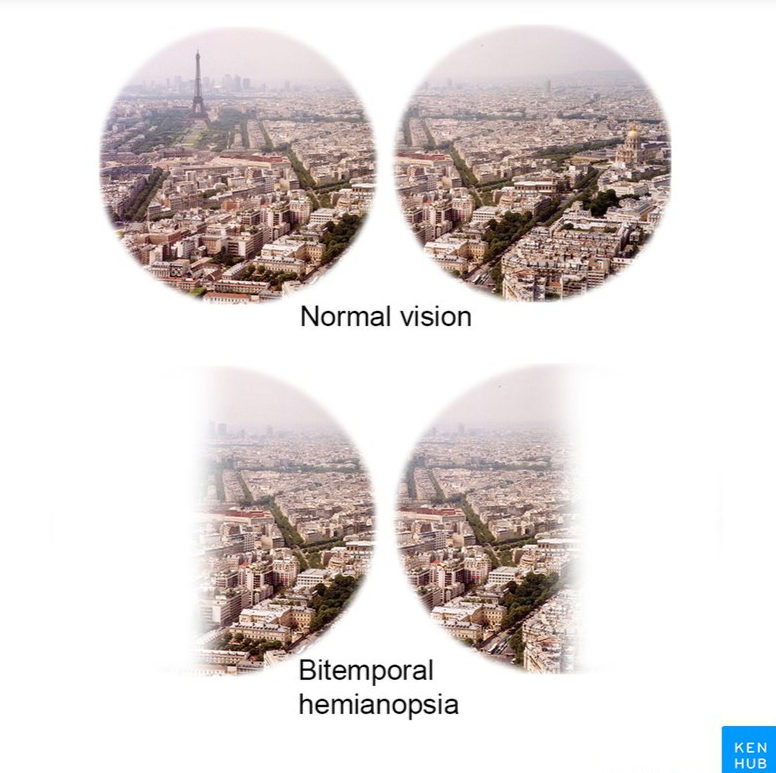 라스케 낭종 (Rathke's cleft cyst) : 네이버 블로그