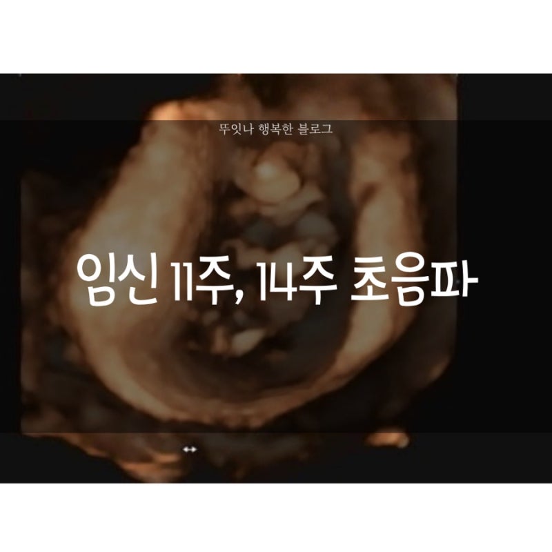 임신 11주 초음파 임신 14주 초음파 자궁경부암 검사 기형아 1차 2차 검사 정밀초음파 네이버 블로그