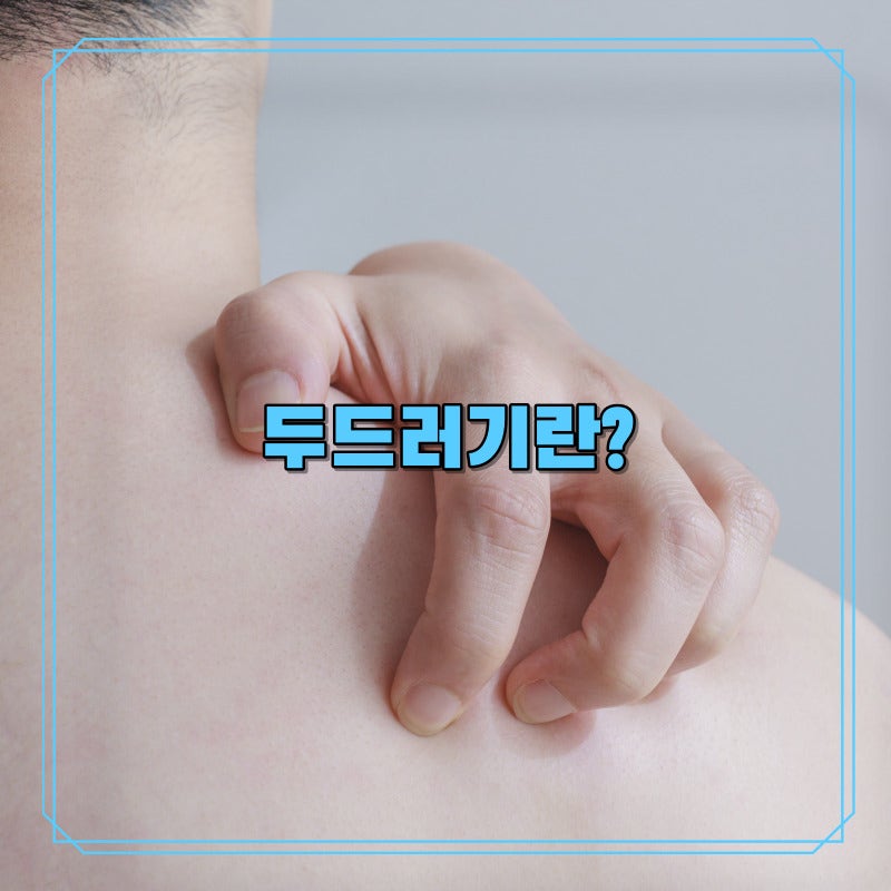 몸에 전신 두드러기 증상 및 원인 치료 피부 두드러기약 네이버 블로그