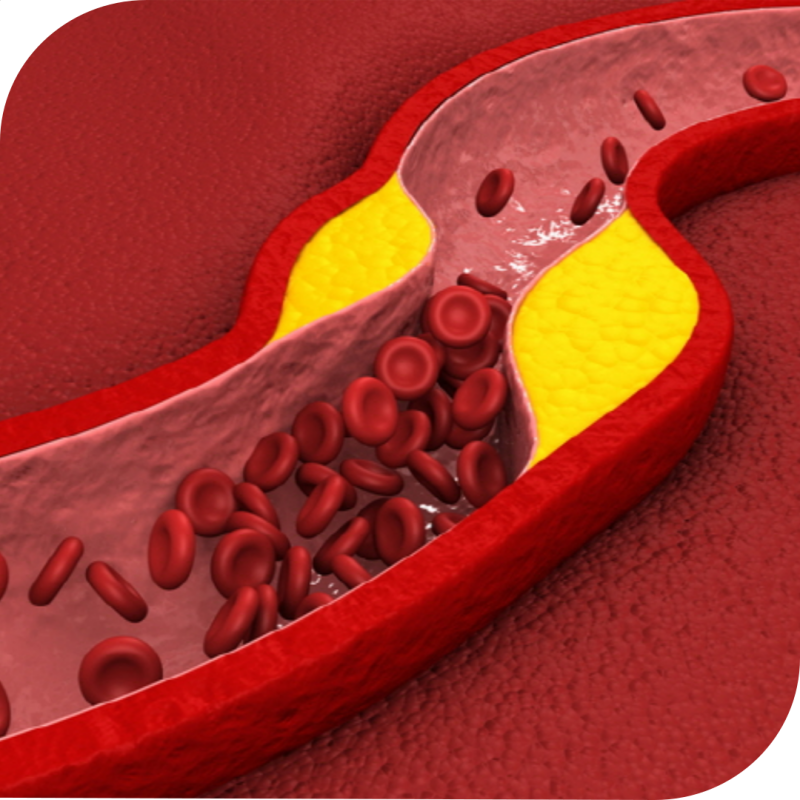 의학용어 CVA, SDH, EDH, SAH, ICH, IVH 뇌혈관계 질환 종류 : 네이버 블로그