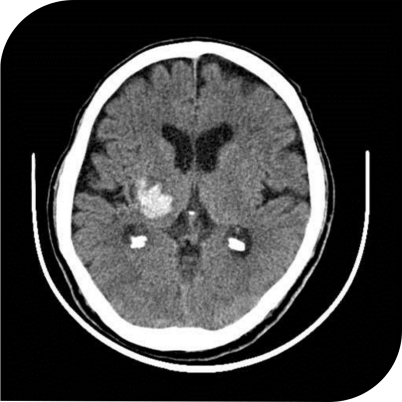 의학용어 CVA, SDH, EDH, SAH, ICH, IVH 뇌혈관계 질환 종류 : 네이버 블로그