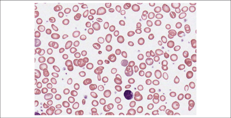 2. 적혈구계 ③ : 네이버 블로그