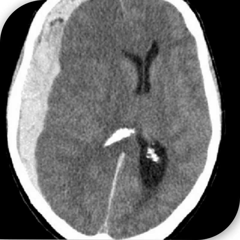 의학용어 CVA, SDH, EDH, SAH, ICH, IVH 뇌혈관계 질환 종류 : 네이버 블로그