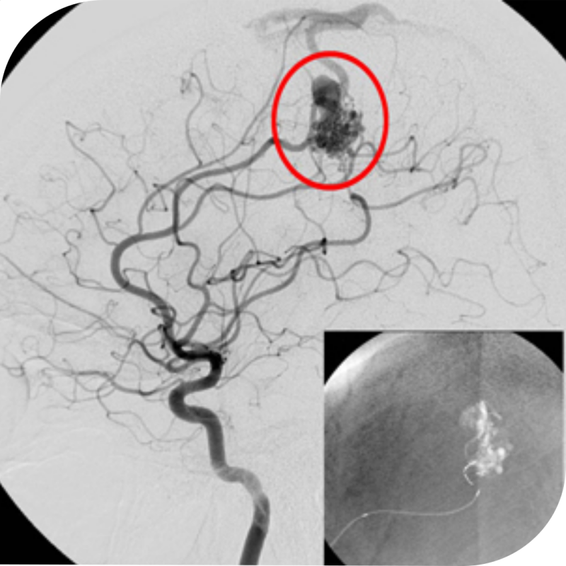 의학용어 CVA, SDH, EDH, SAH, ICH, IVH 뇌혈관계 질환 종류 : 네이버 블로그