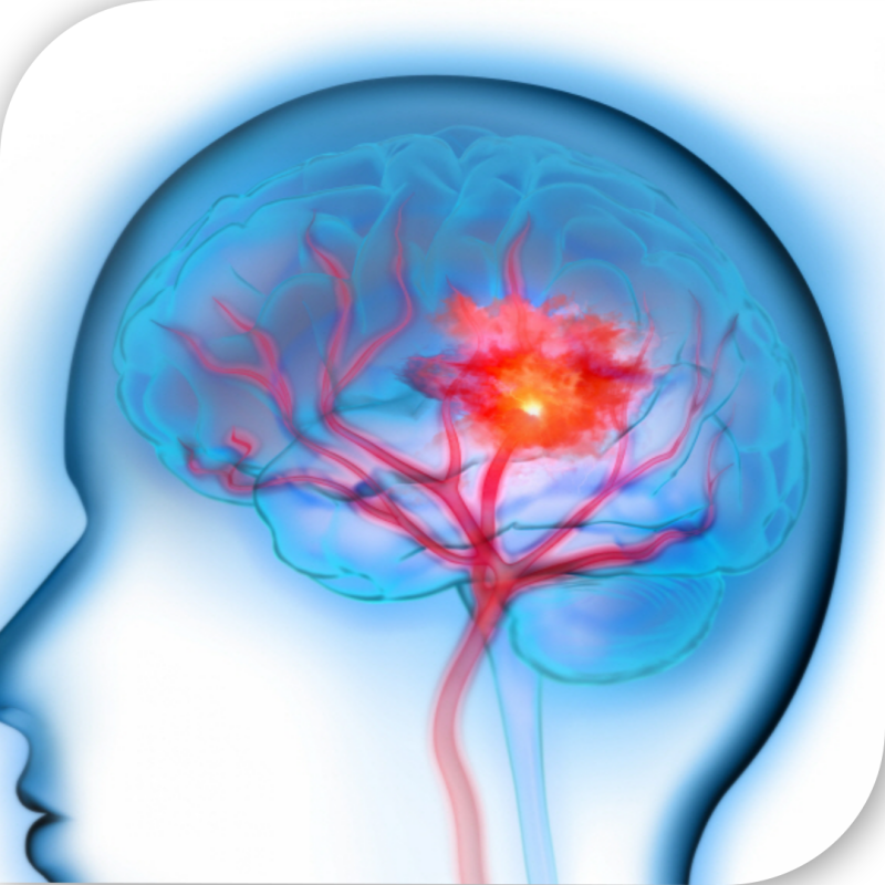 의학용어 CVA, SDH, EDH, SAH, ICH, IVH 뇌혈관계 질환 종류 : 네이버 블로그