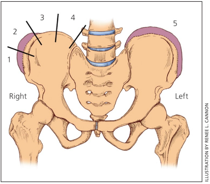 Risser stage & 척추측만증 : 네이버 블로그