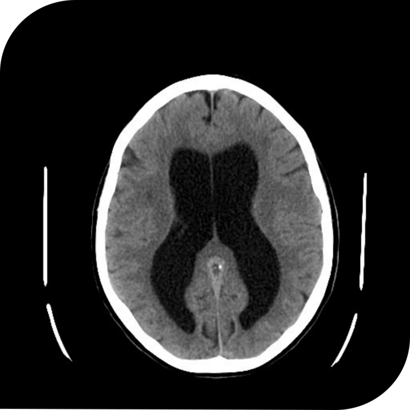 의학용어 CVA, SDH, EDH, SAH, ICH, IVH 뇌혈관계 질환 종류 : 네이버 블로그