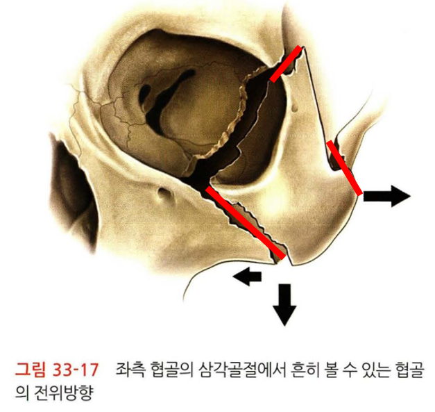 안면골절 (1) - 삼각골절(Tripod fracture) : 네이버 블로그