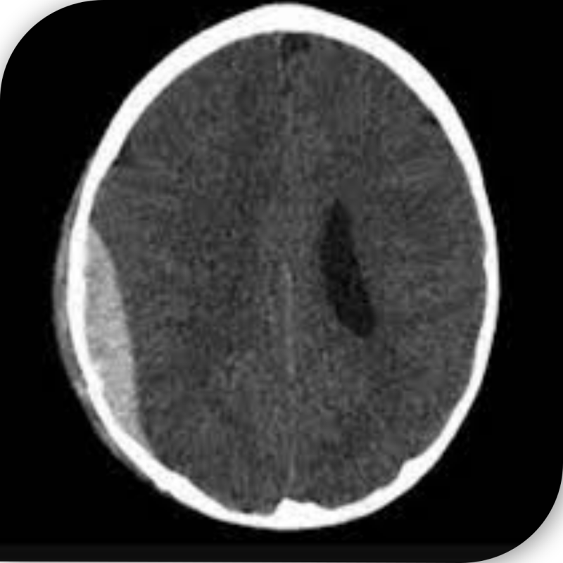 의학용어 CVA, SDH, EDH, SAH, ICH, IVH 뇌혈관계 질환 종류 : 네이버 블로그