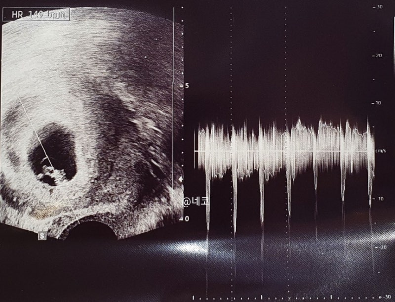 시험관임신7주차 7주 1일차 심장소리 확인 150bpm 세쌍둥이 아기집 확인 입덧약 처방 네이버 블로그
