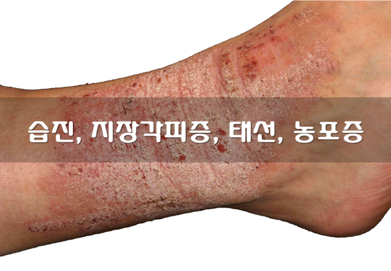 더모베이트 연고 액 스테로이드연고 습진 지장각피증 태선 농포증 성분 가격 사용법 금기 부작용 사용기간 도모호론 베타베이트