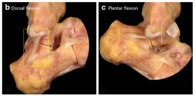 외측 발목 인대 해부학 / 전거비인대(ATFL), 종비인대(CFL), 후거비인대(PTFL), ankle sprain(발목염좌 ...