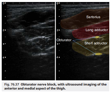 obturator nerve block 폐쇄신경 차단술, 초음파 유도하 신경차단술 방법과 팁 : 네이버 블로그