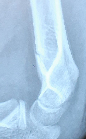 팔꿈치 소아의 정상 팔꿈치 X Ray 과상부 골절supracondylar Fx 외 부위 네이버 블로그