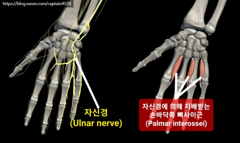 와텐버그 징후(Wartenberg's sign) : Ulnar nerve paralysis - Special test : 네이버 블로그