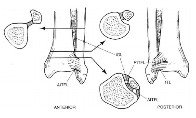 경비인대(syndesmosis) 발목 해부학 / AITFL, PITFL, IOL,IOM / High ankle sprain ...