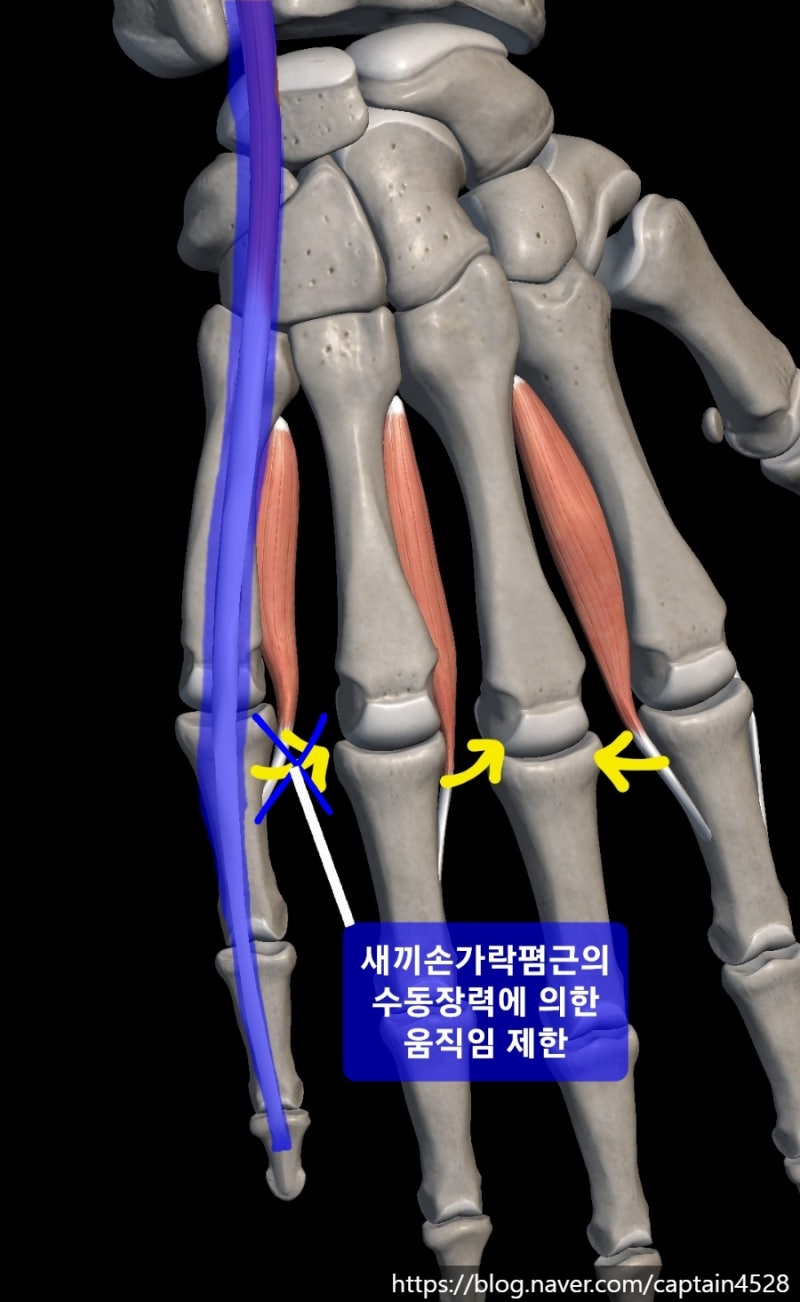 와텐버그 징후(Wartenberg's sign) : Ulnar nerve paralysis - Special test : 네이버 블로그