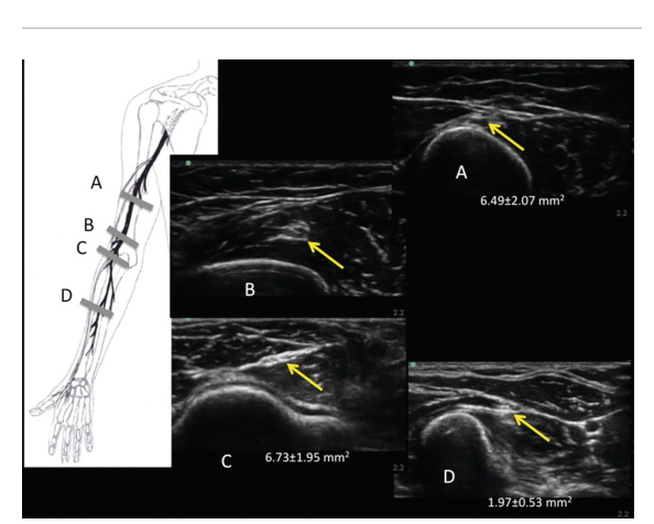 Radial nerve block 요골 신경 차단술(1) : 요골신경 주행 방향과 초음파, 적응증 : 네이버 블로그