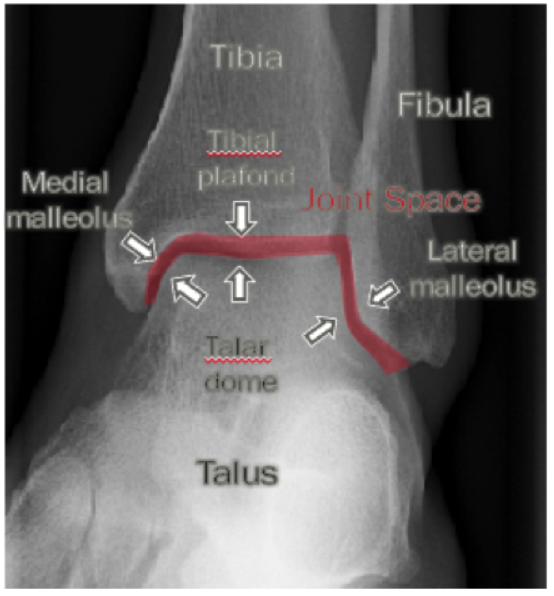 경비인대(syndesmosis) 발목 해부학 / AITFL, PITFL, IOL,IOM / High ankle sprain ...