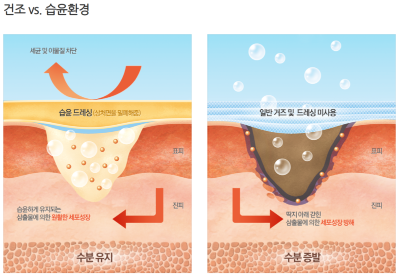 습윤드레싱 습윤밴드 종류 비교 하이드로겔 Vs 하이드로콜로이드 Vs 폼 드레싱 등 사용법 Ft 메디폼 듀오덤