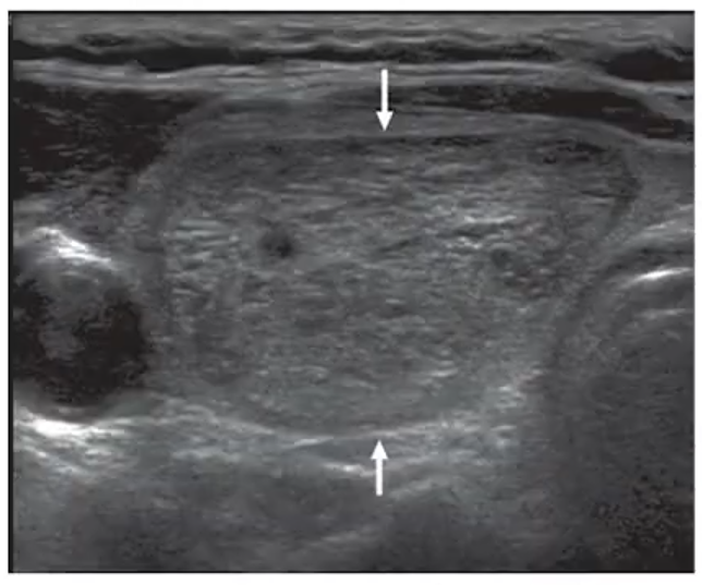 K-TIRADS 2021에 따른 갑상선 결절의 평가 : 네이버 블로그