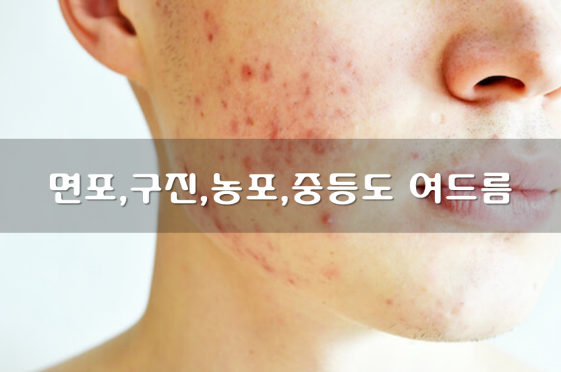 아크리프 크림 얼굴 몸 여드름 신약 처방 약국약 성분 사용법 금기 부작용 사용기간 연고 네이버 블로그