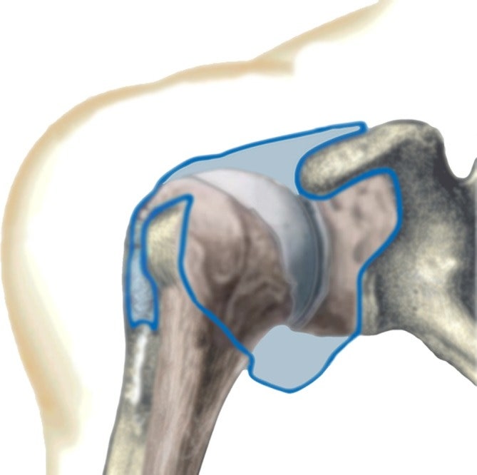 오십견 frozen shoulder의 진단 axillary recess thickness CHL 초음파검사 : 네이버 블로그