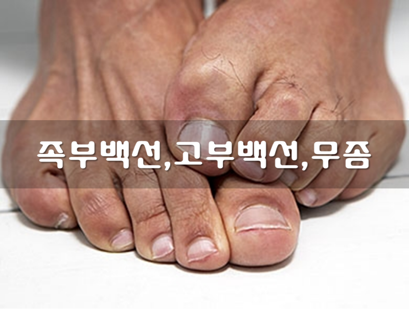 로세릴 크림 항진균제 무좀 약 피부사상균증 족부 백선 한포상 고부 완선 서혜부 체부 부스럼 반상 소수포성 수부 처방 약국약 성분