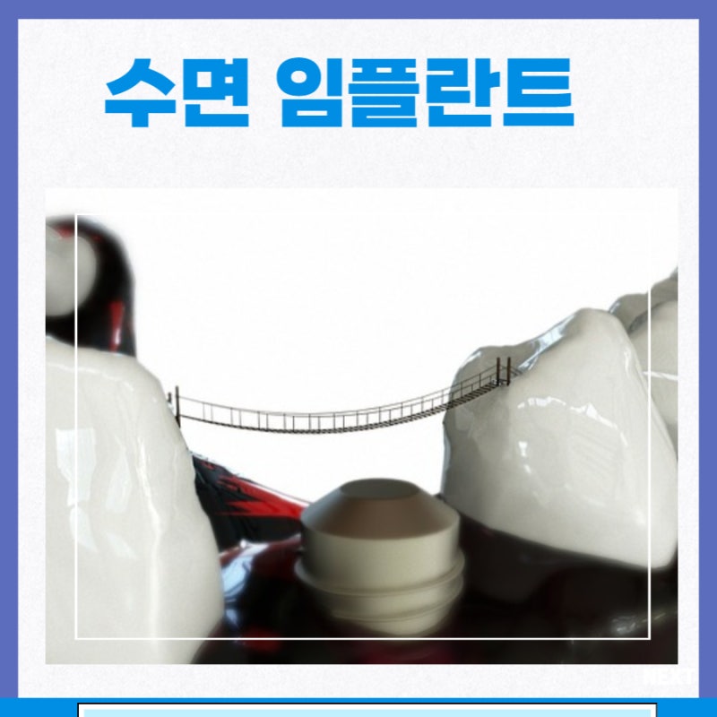 임플란트 종류 수면 네비게이션 원데이 전체 노인 20대 임플란트 비용 네이버 블로그