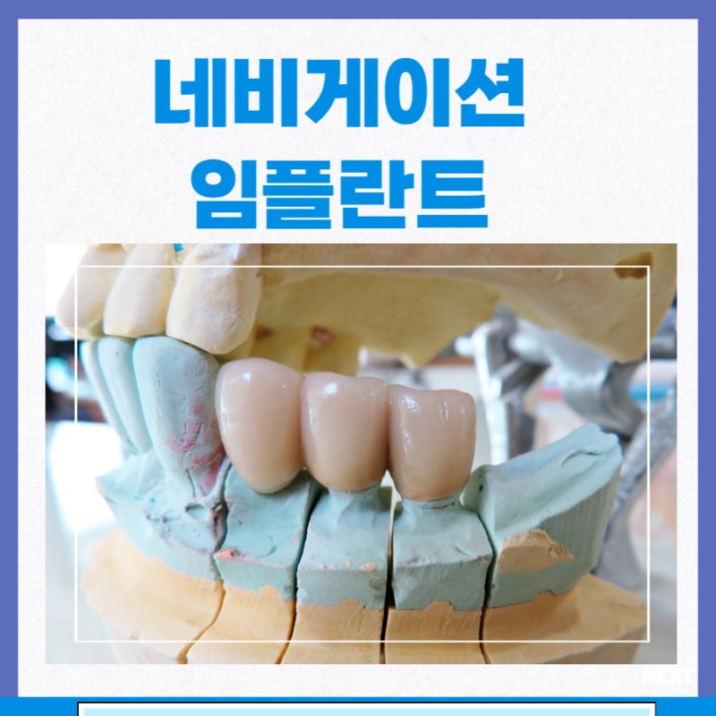 임플란트 종류 수면 네비게이션 원데이 전체 노인 20대 임플란트 비용 네이버 블로그