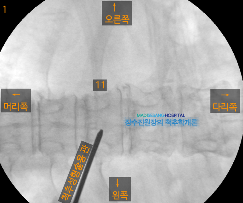 척추 압박골절의 경우 X Ray는 참조만 합니다 네이버 블로그