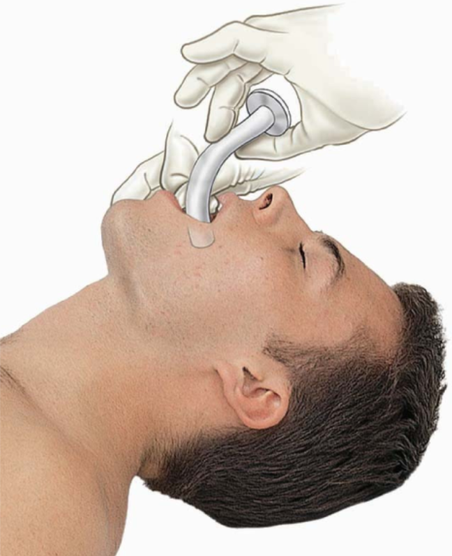 Oropharyngeal airway(구인두 기도기 OPA), Nasopharyngeal airway(비인두 기도기 NPA ...