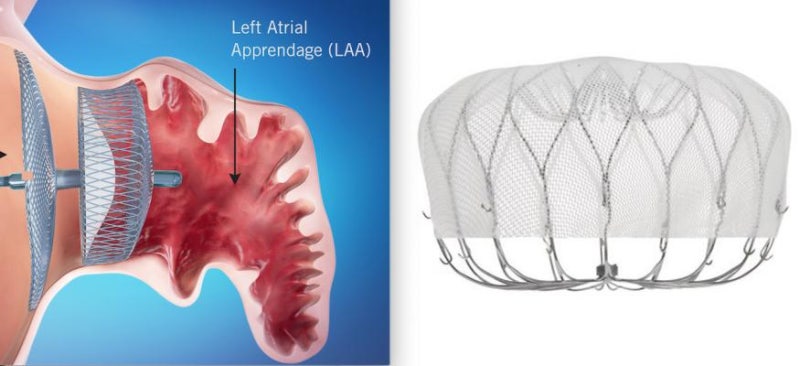 심방세동의 치료 Atrial fibrillation, A-fib, AF : 네이버 블로그