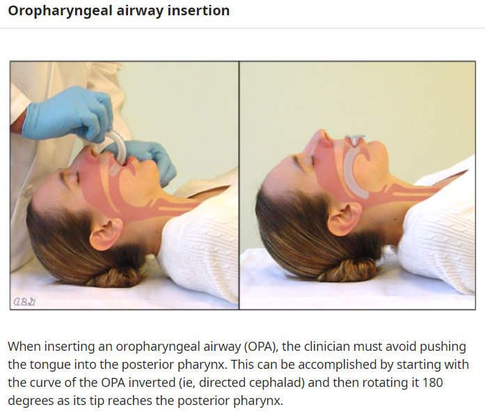 Oropharyngeal airway(구인두 기도기 OPA), Nasopharyngeal airway(비인두 기도기 NPA ...