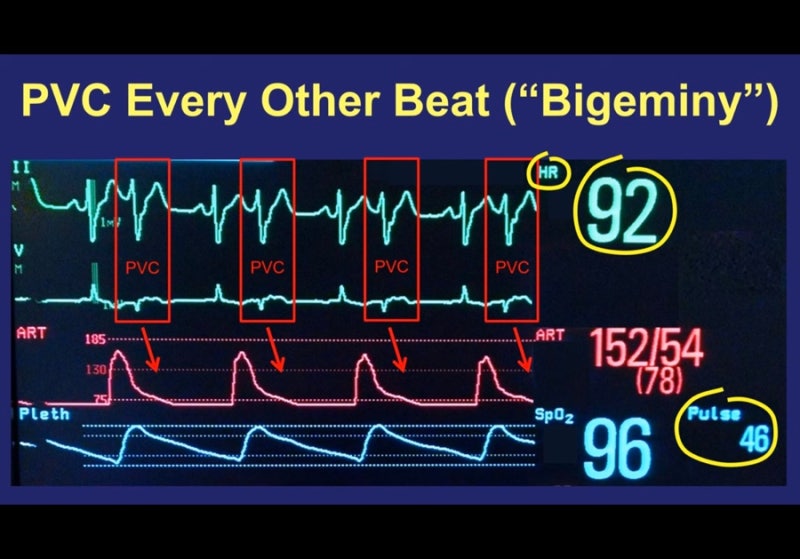 EKG 모니터 해석 - 의학용어 PVC 심실조기수축 공부하기 : 네이버 블로그