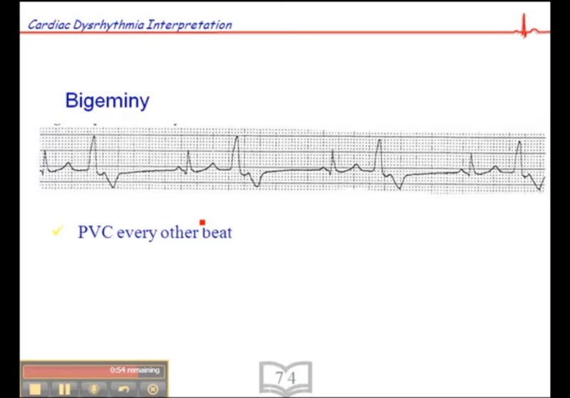 EKG 모니터 해석 - 의학용어 PVC 심실조기수축 공부하기 : 네이버 블로그