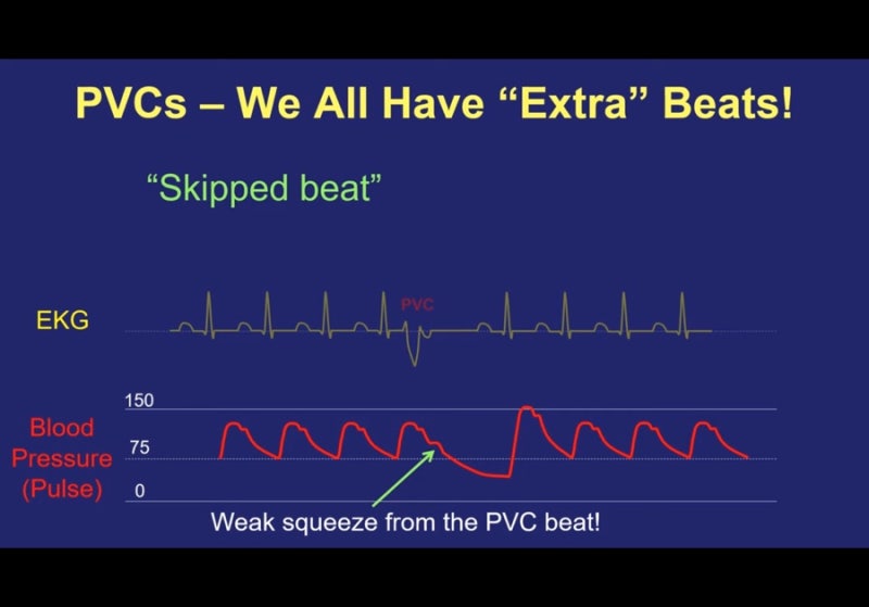 Ekg 모니터 해석 의학용어 Pvc 심실조기수축 공부하기 네이버 블로그
