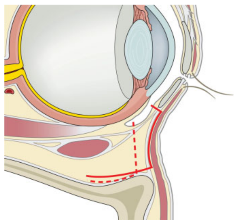 [안와골절] 안와골절의 진단 및 치료 : 네이버 블로그
